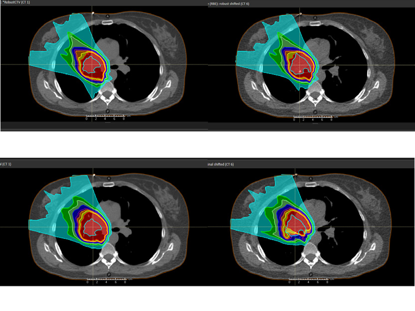 Robust optimization in RayStation | RaySearch Laboratories