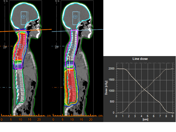 Robust optimization in RayStation | RaySearch Laboratories