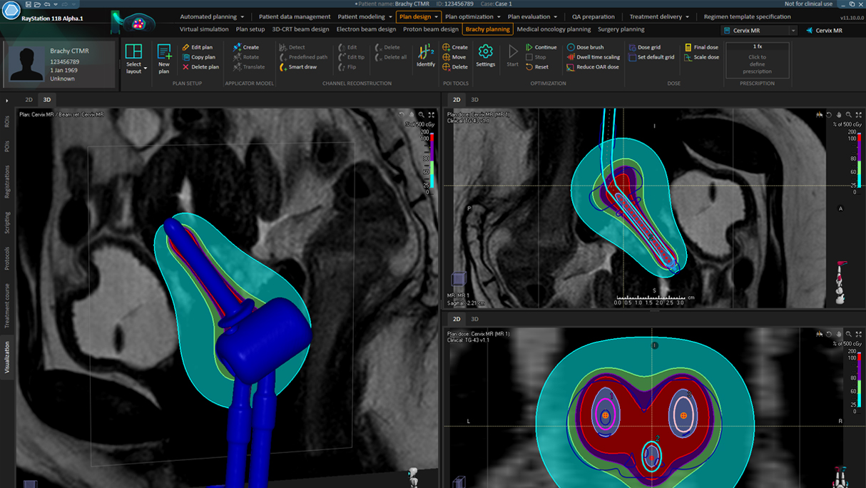 Brachytherapy in RayStation | RaySearch Laboratories